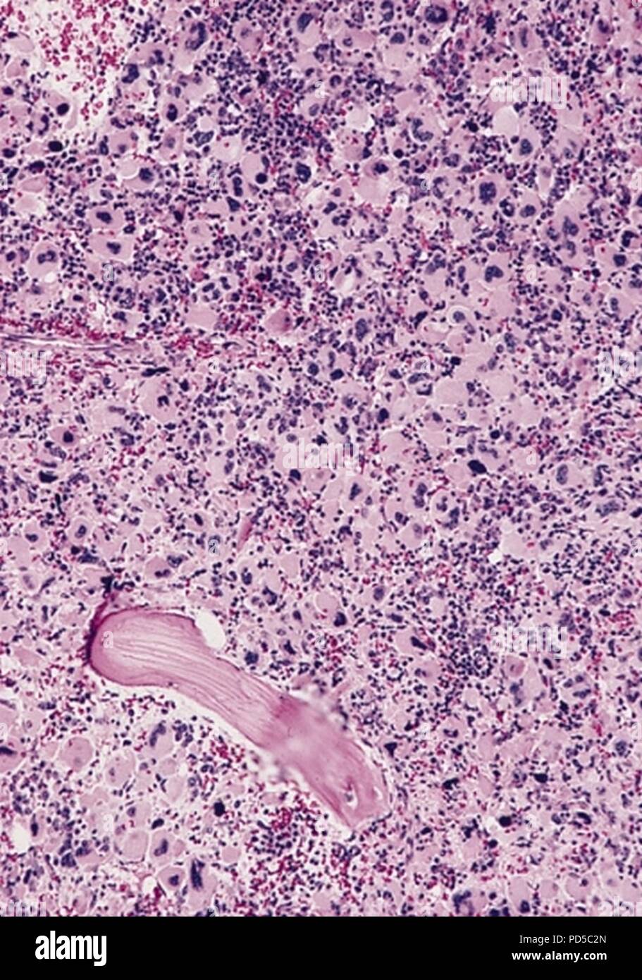 AML-M7 bone marrow section Stock Photo - Alamy