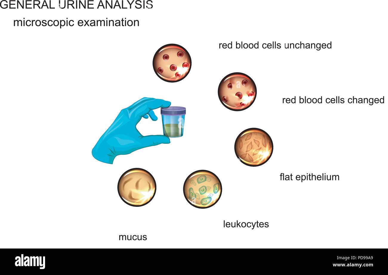 vector illustration of the General analysis of urine. microscopy Stock ...