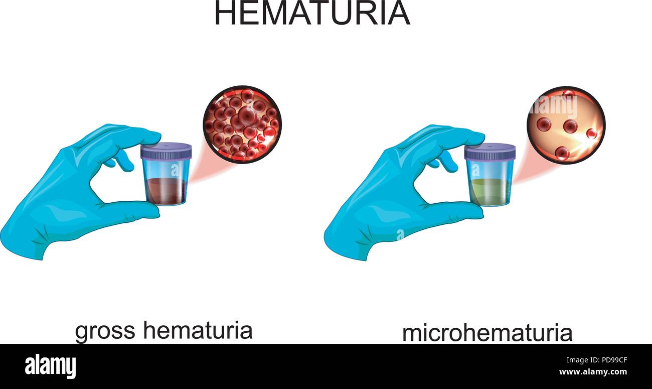 vector illustration of hematuria. blood in urine Stock Vector Image ...