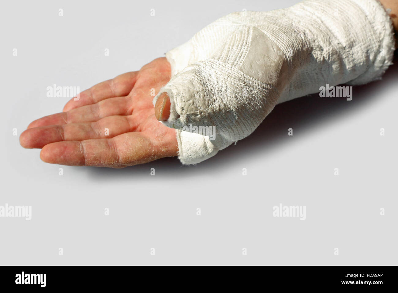 fractured hand of a man with the orthopedic cast after the accident on ...