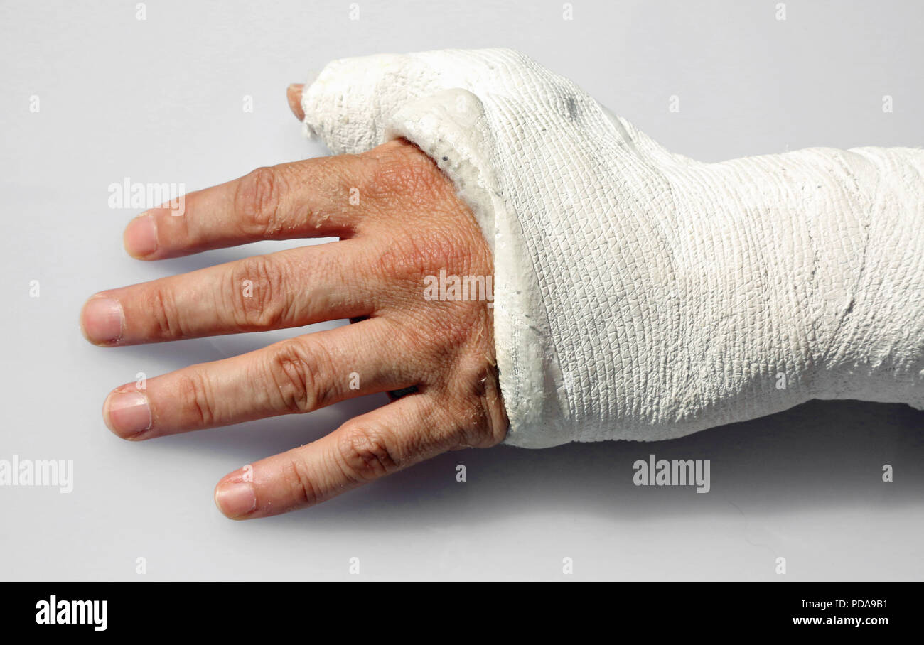 fractured hand with the white orthopedic cast after the accident Stock ...