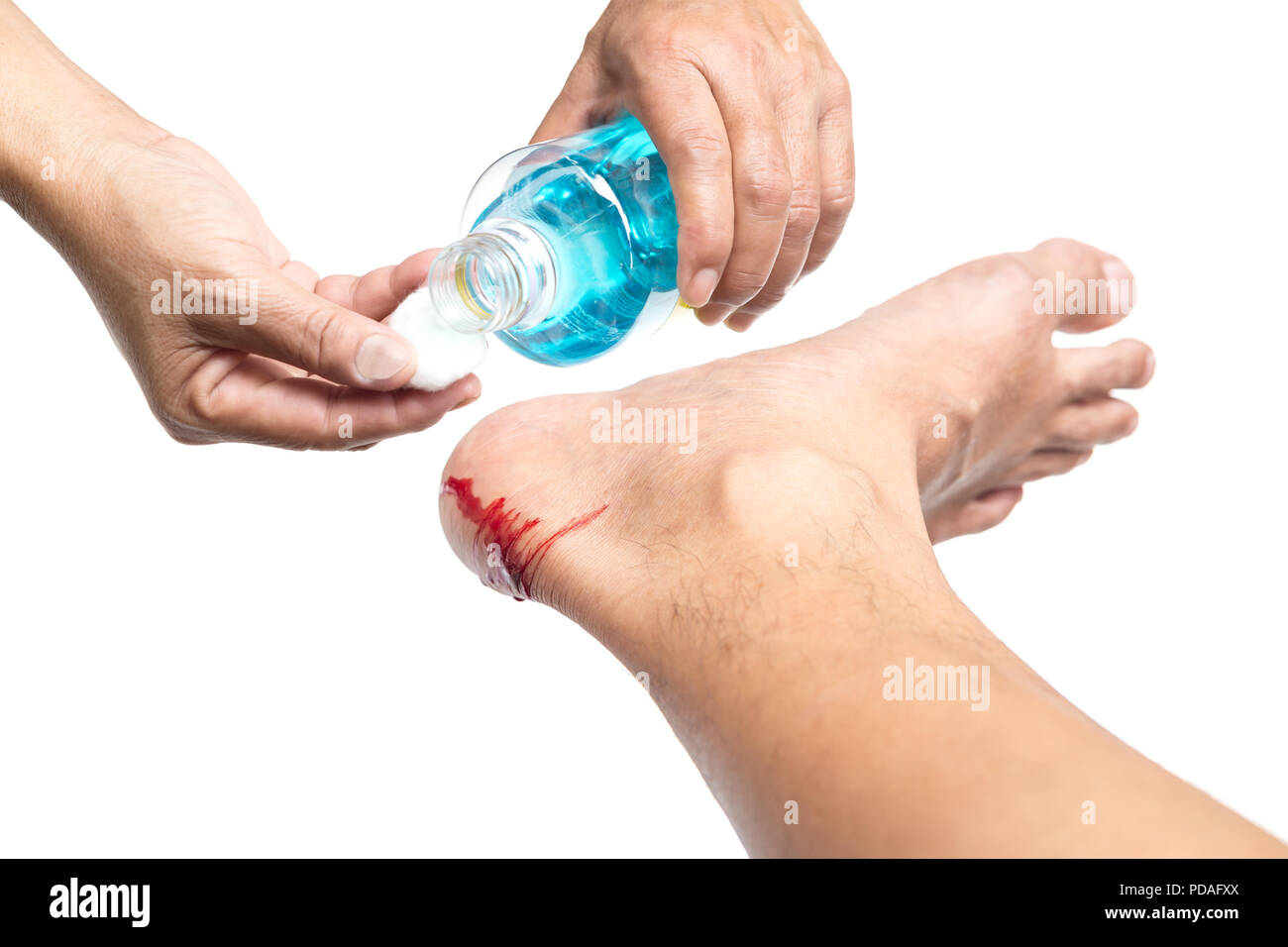 Nurse cleaning wound on patient with Isopropyl alcohol isolated in ...