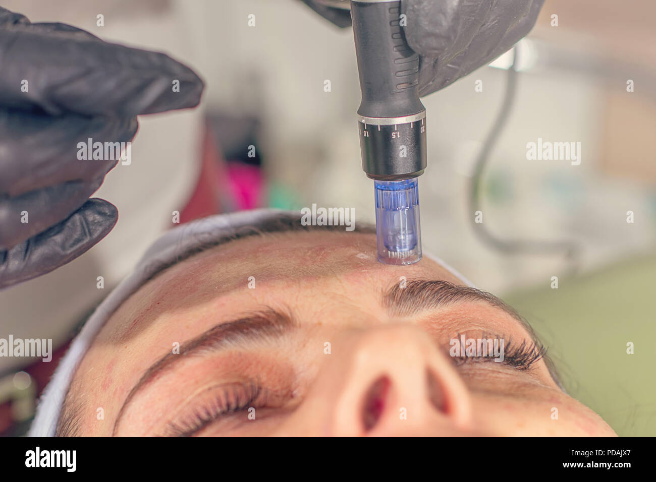 Needle mesotherapy treatment on a woman face Stock Photo - Alamy