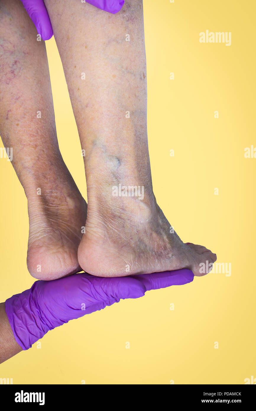 Lower limb vascular examination because suspect of venous insufficiency ...