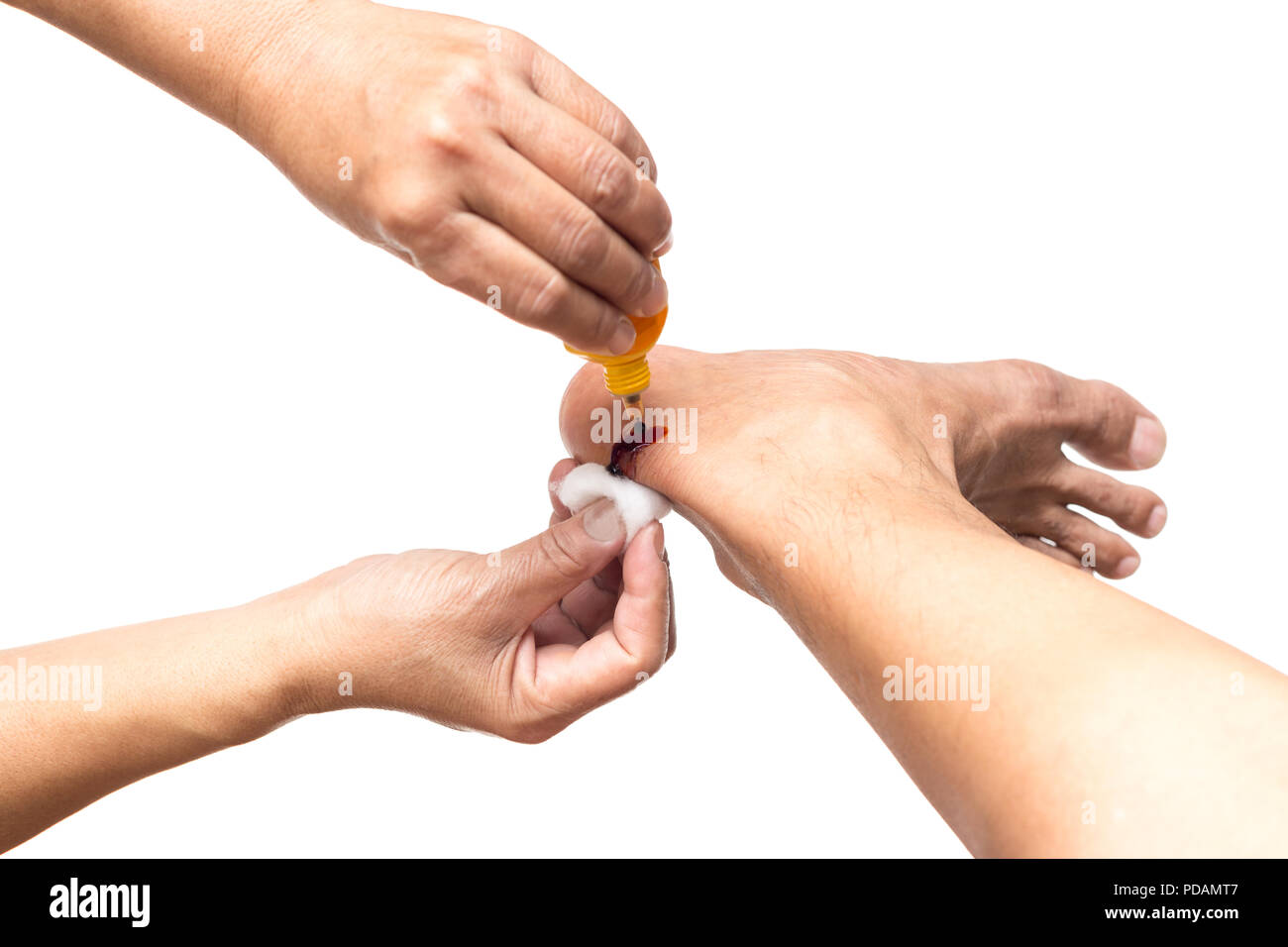 Iodine wound hi-res stock photography and images - Alamy