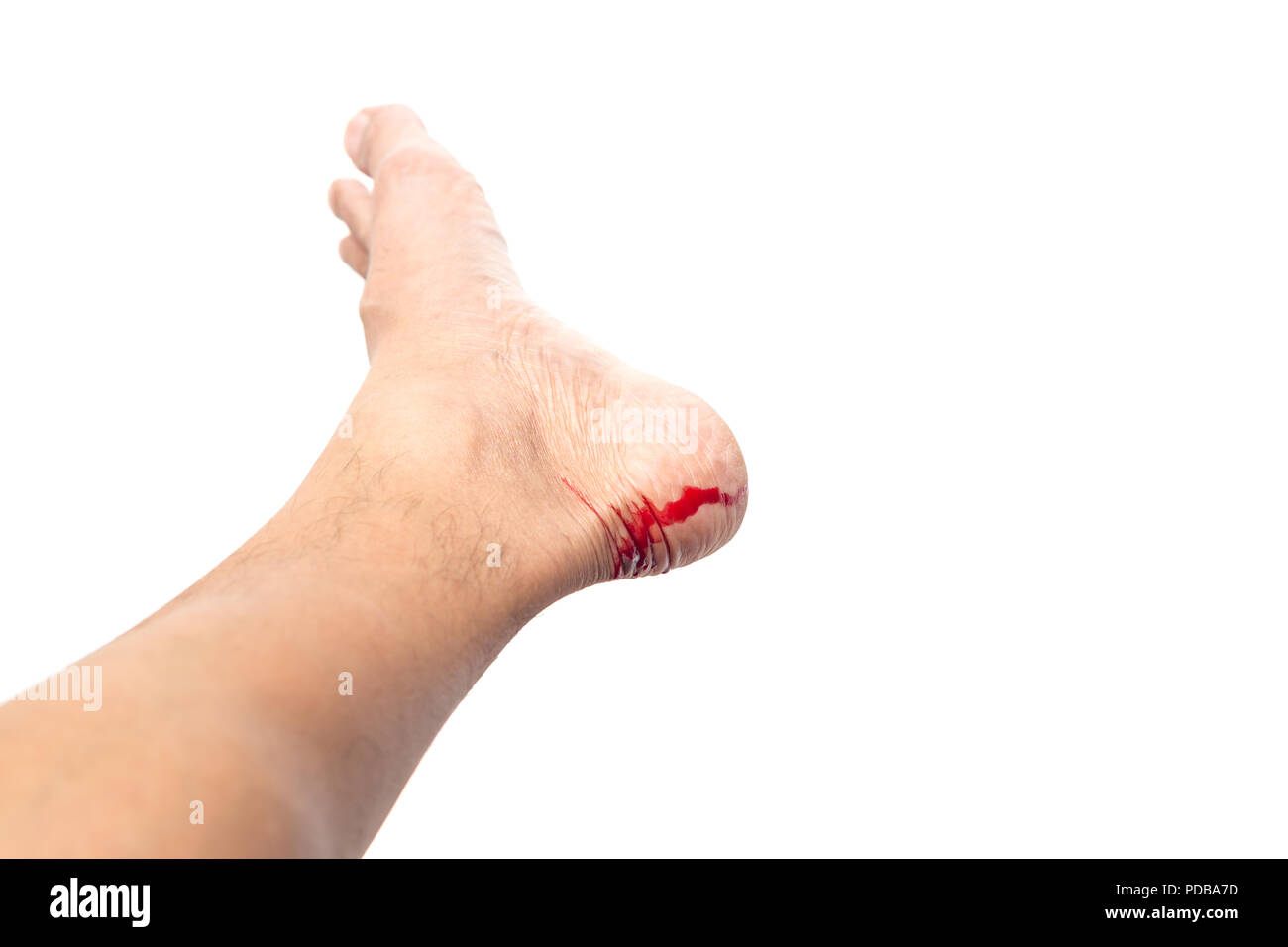 Feet injury breaking skin with bleeding blood isolated in white ...