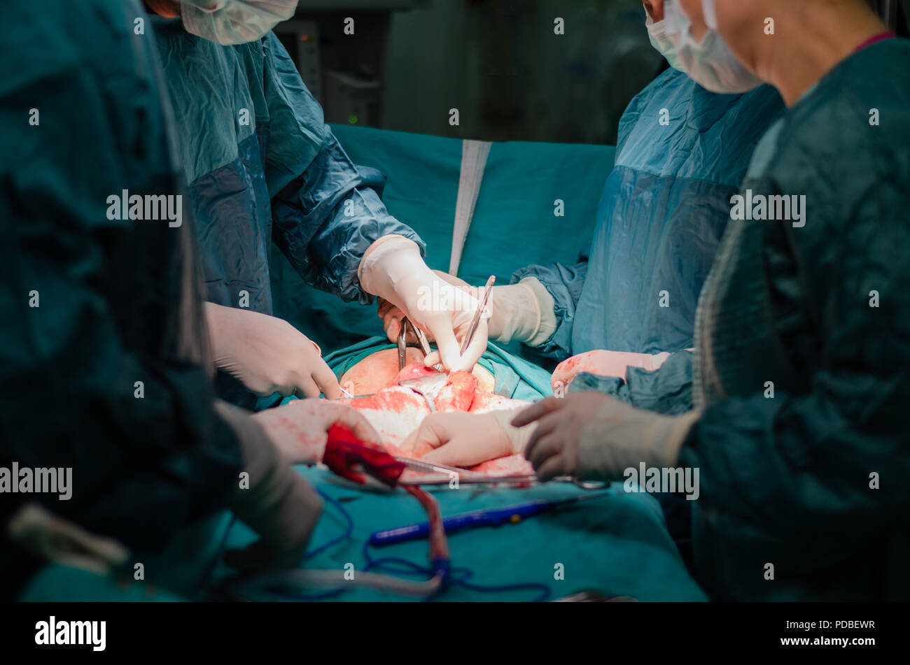 Abdominal hysterectomy hi-res stock photography and images - Alamy