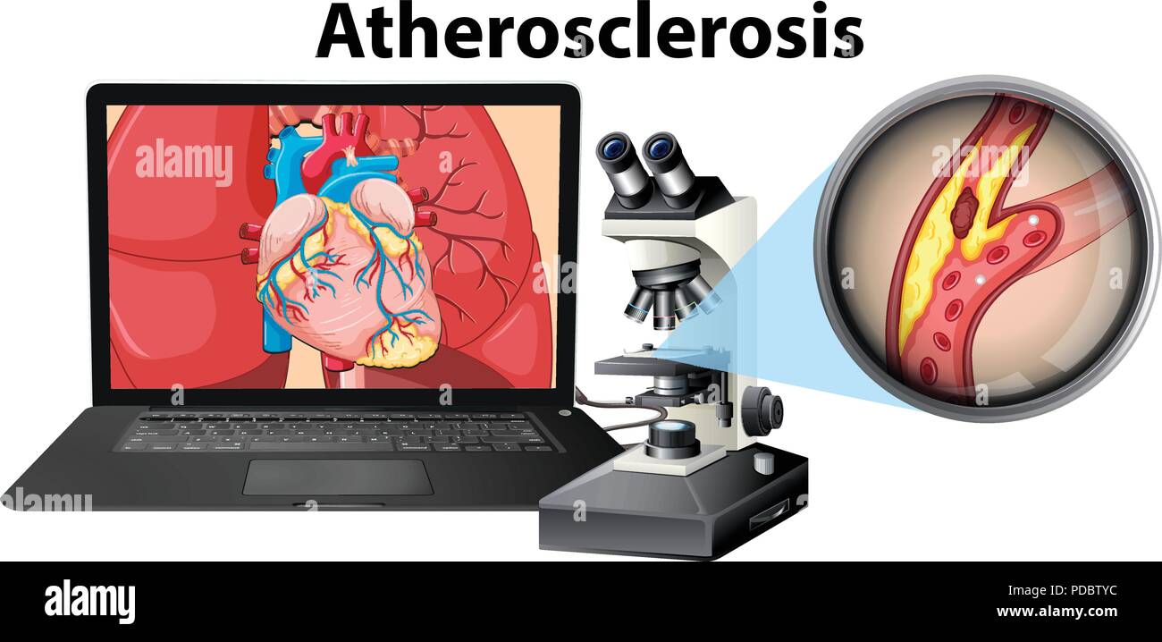 Atherosclerosis microscope hi-res stock photography and images - Alamy