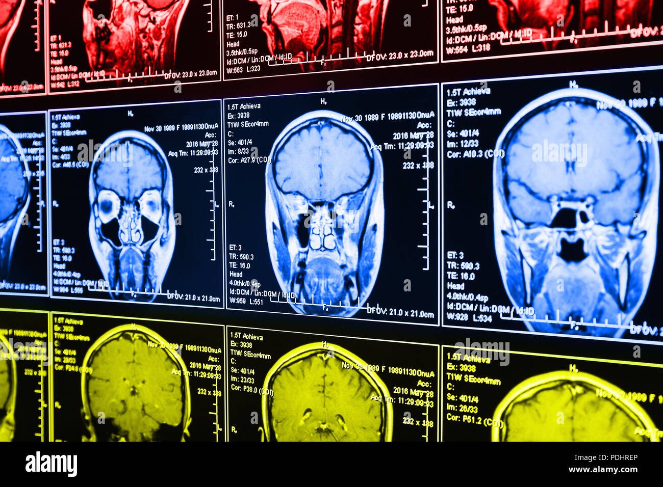 Magnetic resonance scan of the brain. MRI head scan Stock Photo - Alamy