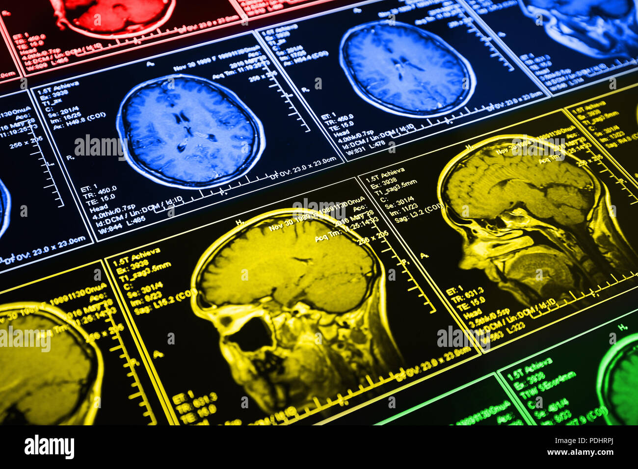 Magnetic resonance scan of the brain. MRI head scan Stock Photo - Alamy