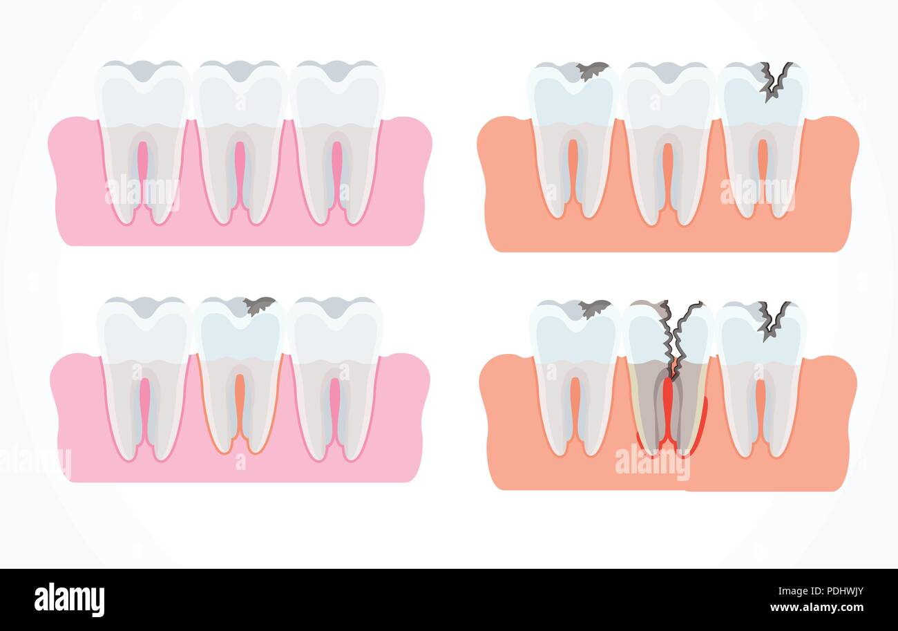 Stages of tooth decay with caries. Dentistry and oral care Stock Vector ...