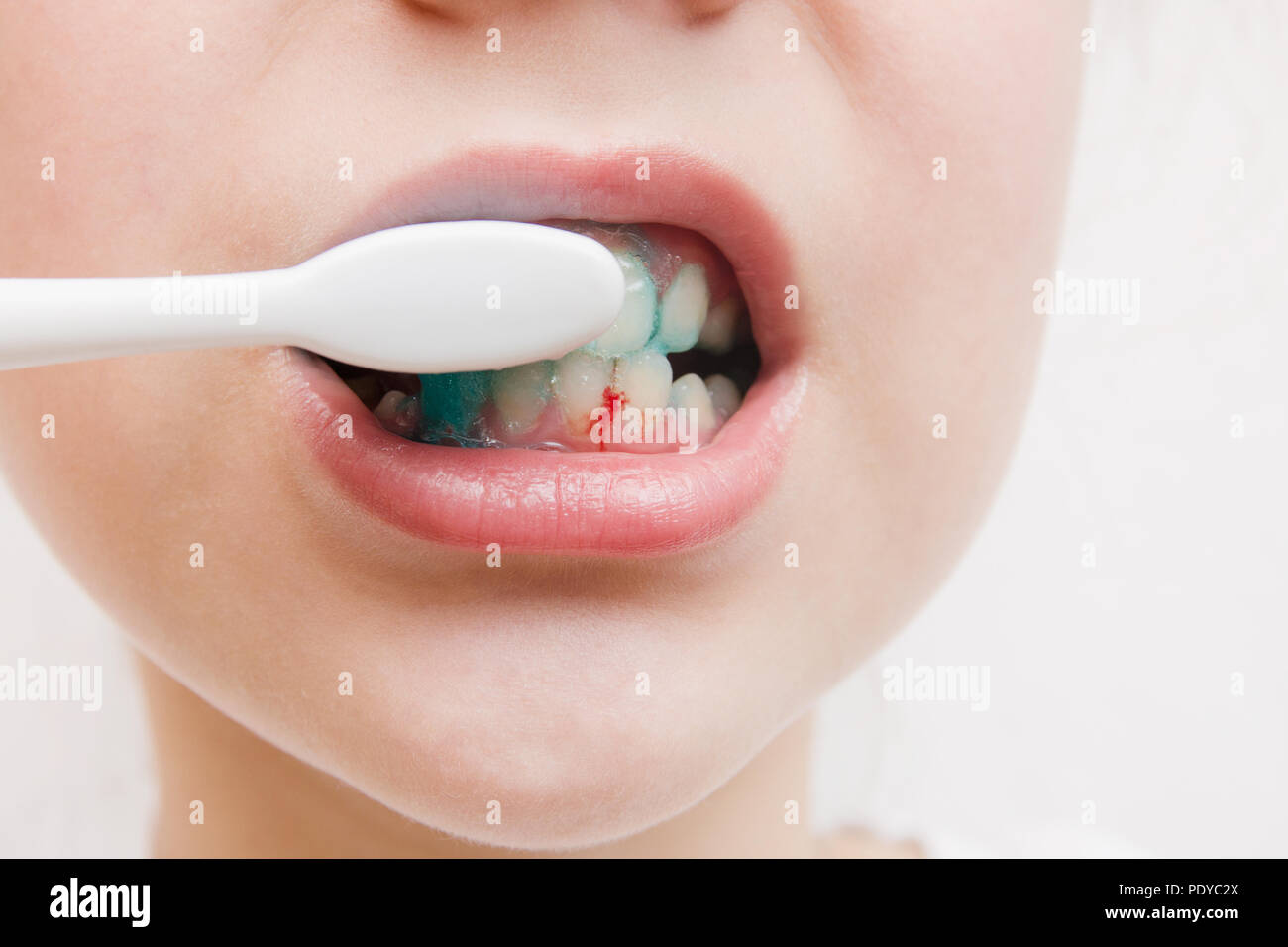 Bleeding at teeth during brushing with toothbrush.scurvy Stock Photo ...