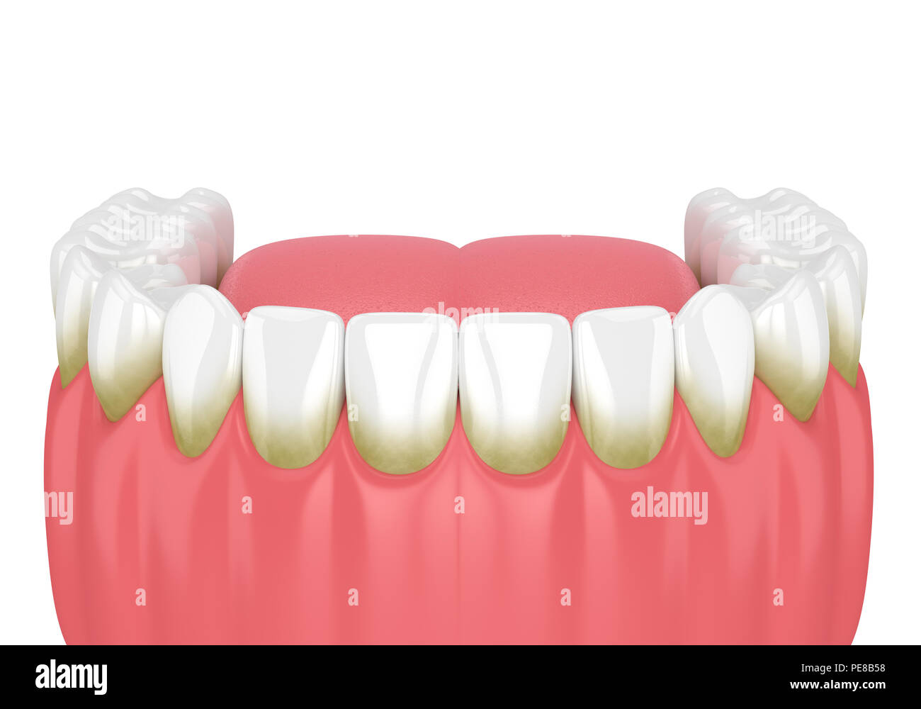 3d render of teeth with plaque and tartar over white background Stock ...