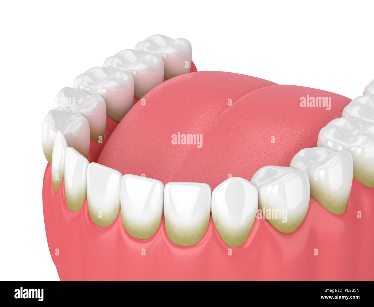 3d render of teeth with plaque and tartar over white background Stock ...