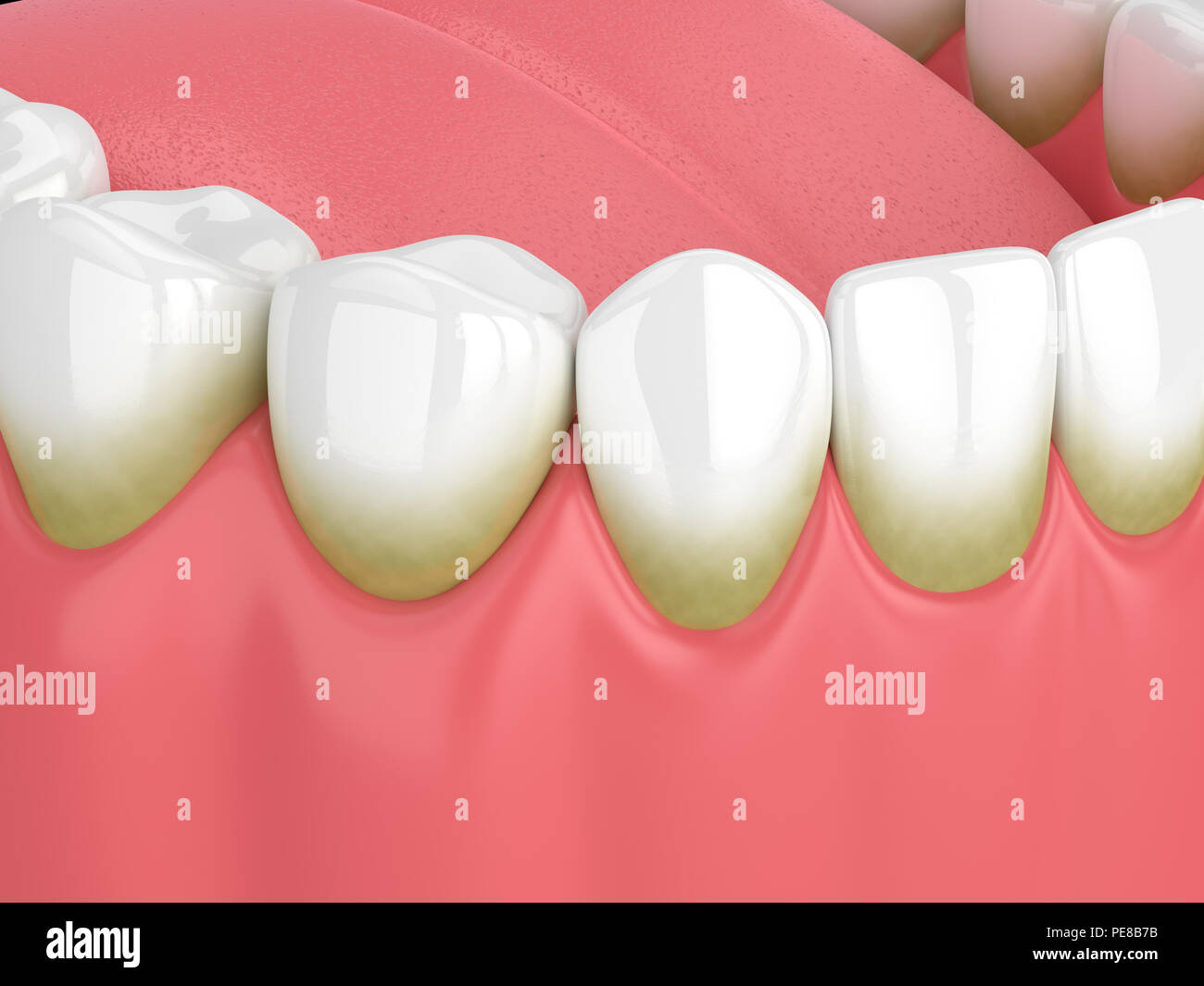 Tartar teeth hi-res stock photography and images - Alamy