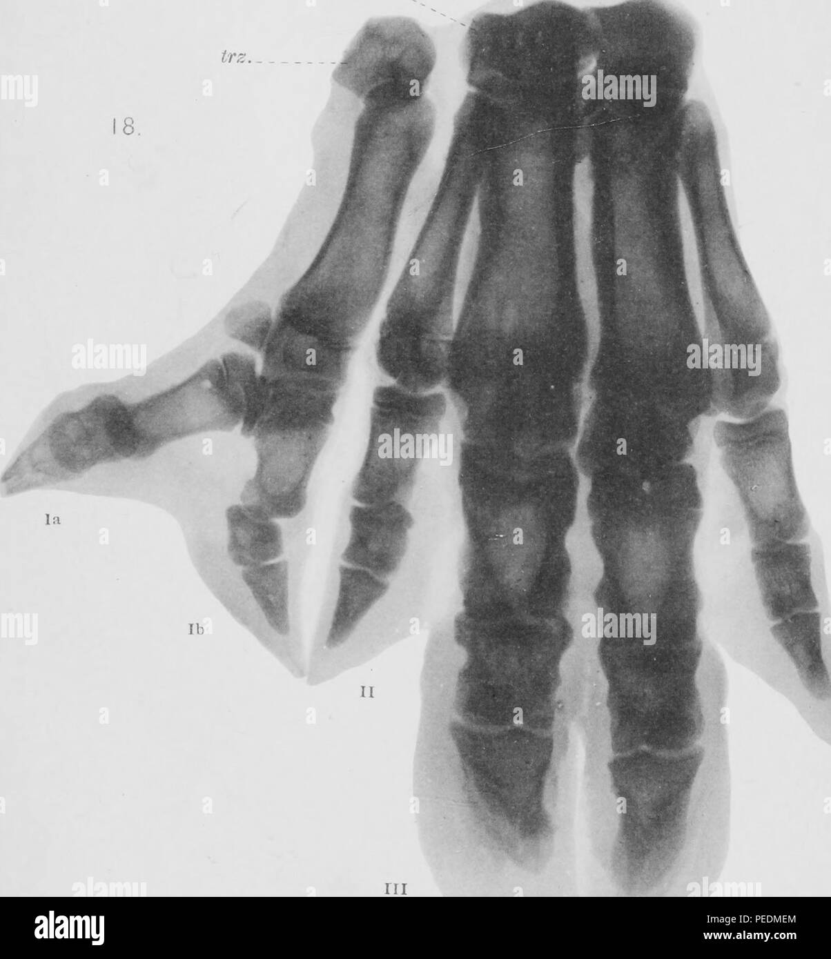 Polydactyl x ray hi-res stock photography and images - Alamy