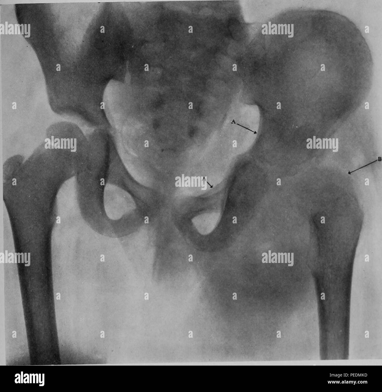 Osteomyelitis hi-res stock photography and images - Alamy