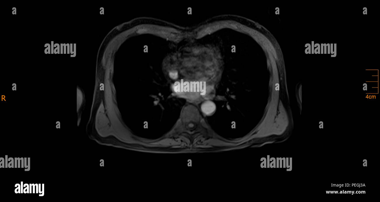 Cross section Abdomen MRI scan of a 60 year old male patient. This ...
