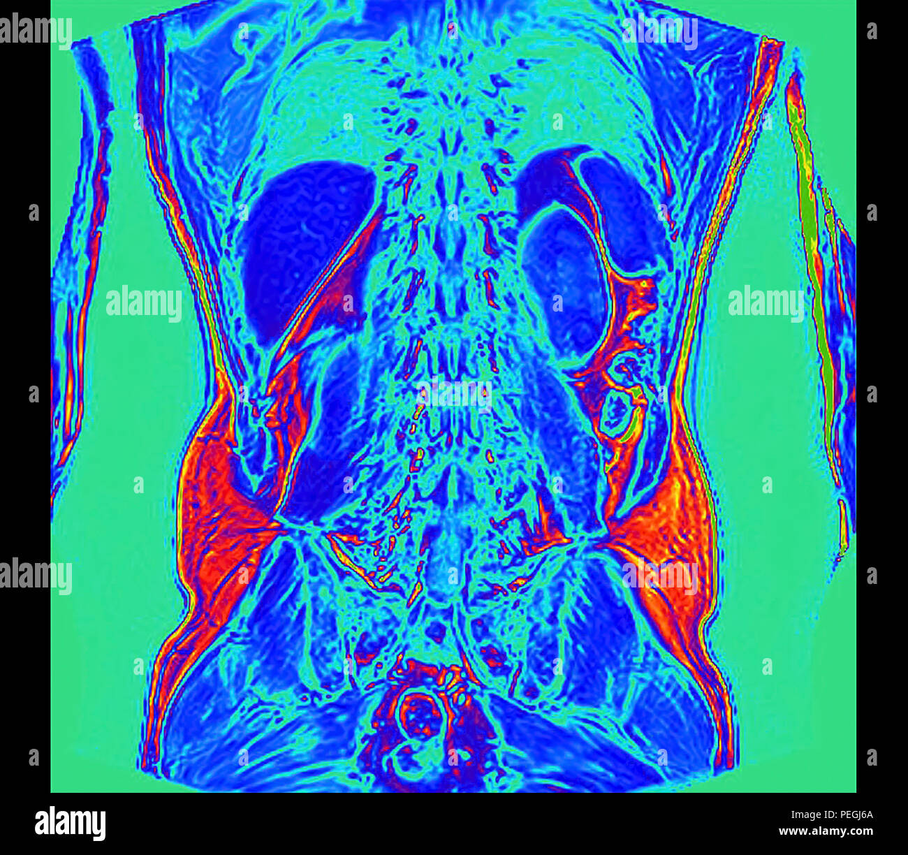 Connective tissue disorder hi-res stock photography and images - Alamy