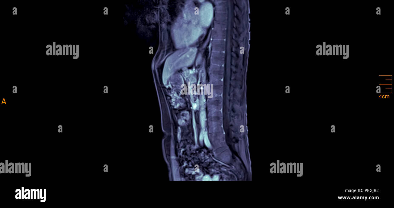 Kidney tumor mri hi-res stock photography and images - Alamy