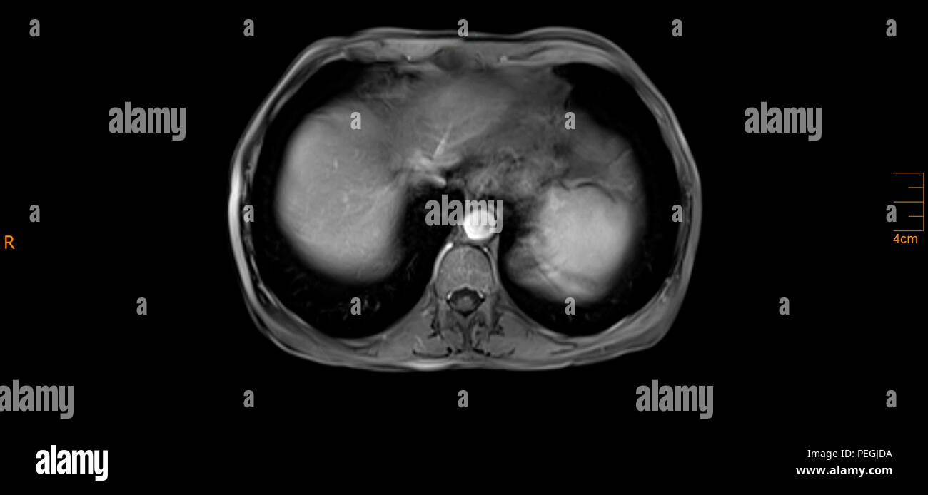 Kidney tumor mri hi-res stock photography and images - Alamy