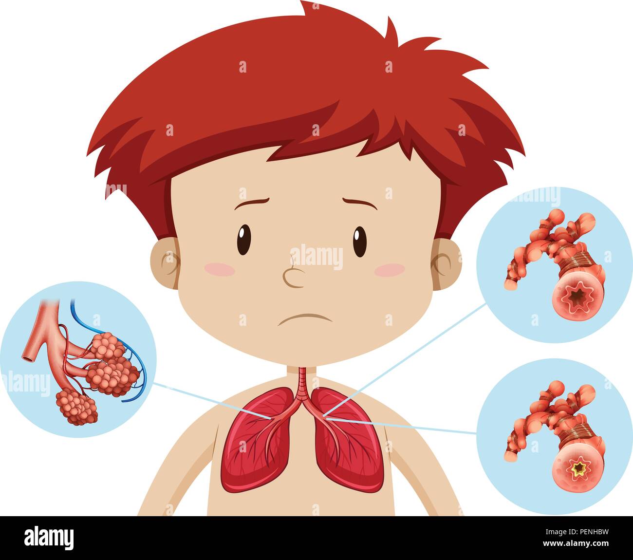 A boy with bronchitis illustration Stock Vector Image & Art - Alamy