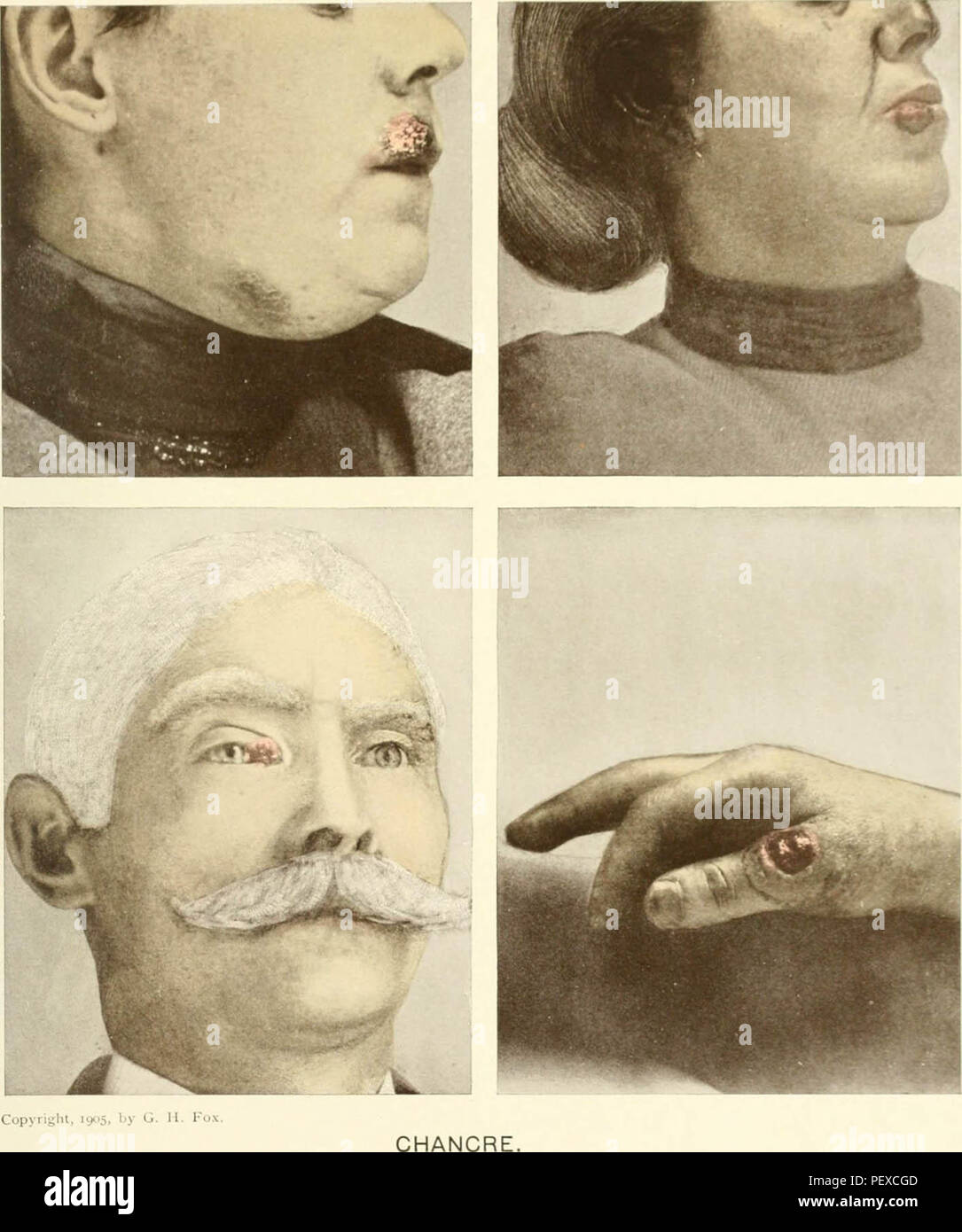 "Photographic atlas of the diseases of the skin a series of ninety-six ...