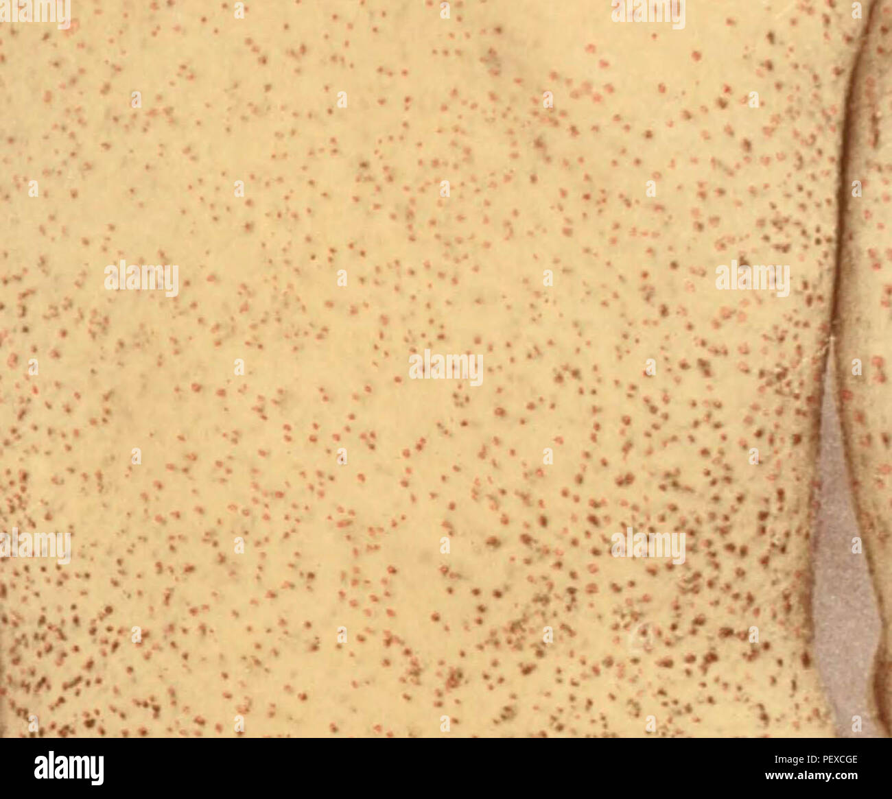 Atlas of skin diseases hi-res stock photography and images - Alamy