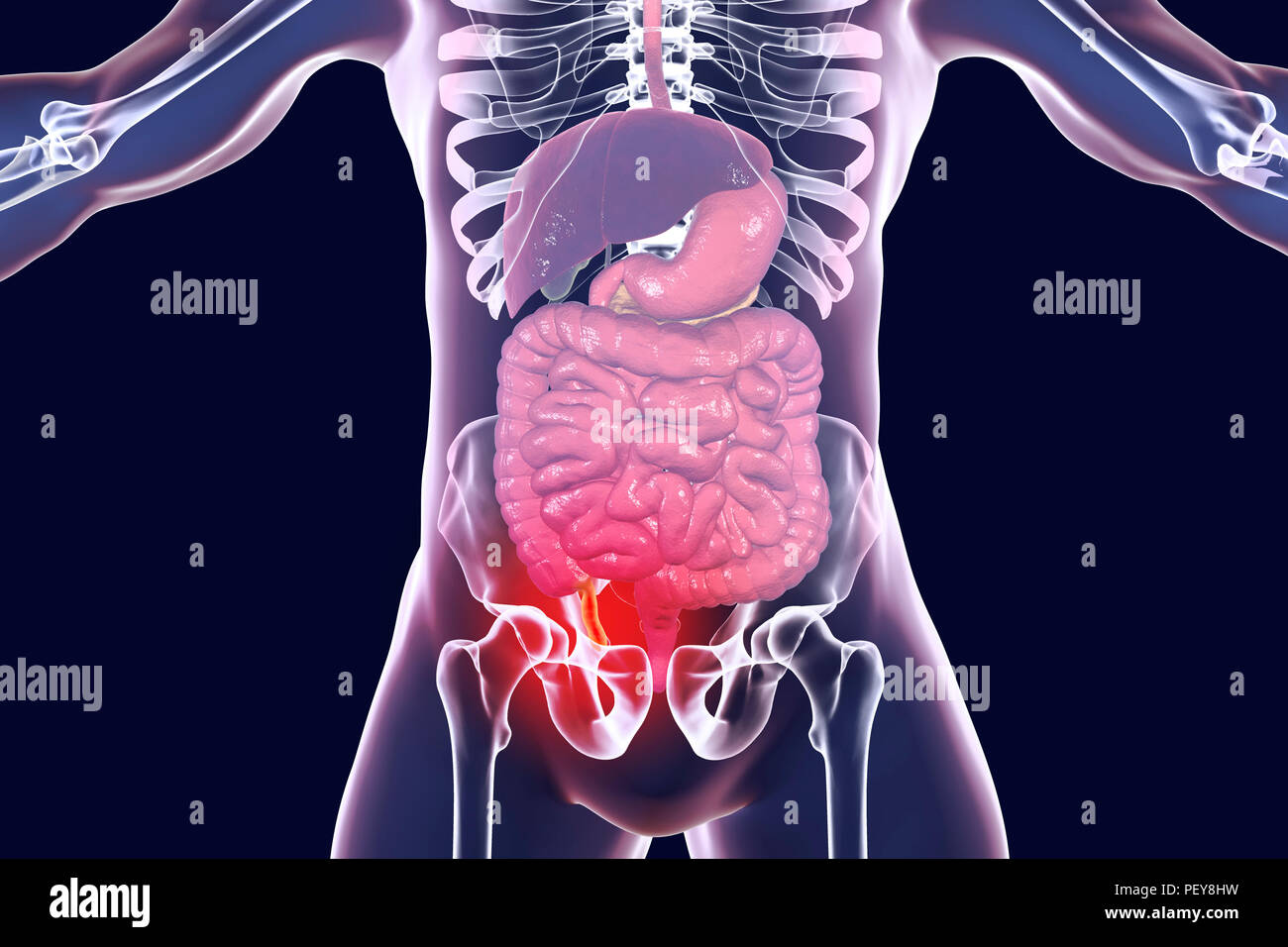 Human Appendix Inflamed
