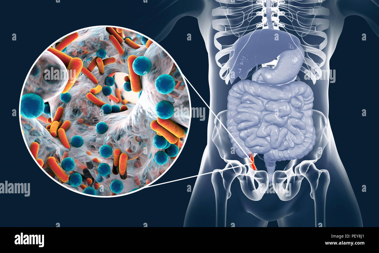 Appendicitis. Illustration of a human appendix, showing it red and ...