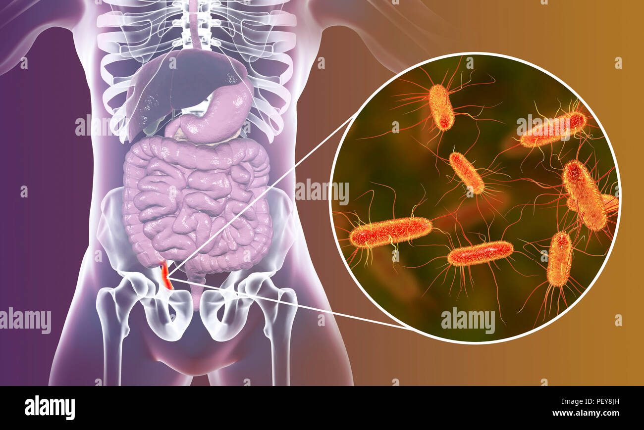 Appendicitis. Illustration of a human appendix, showing it red and ...