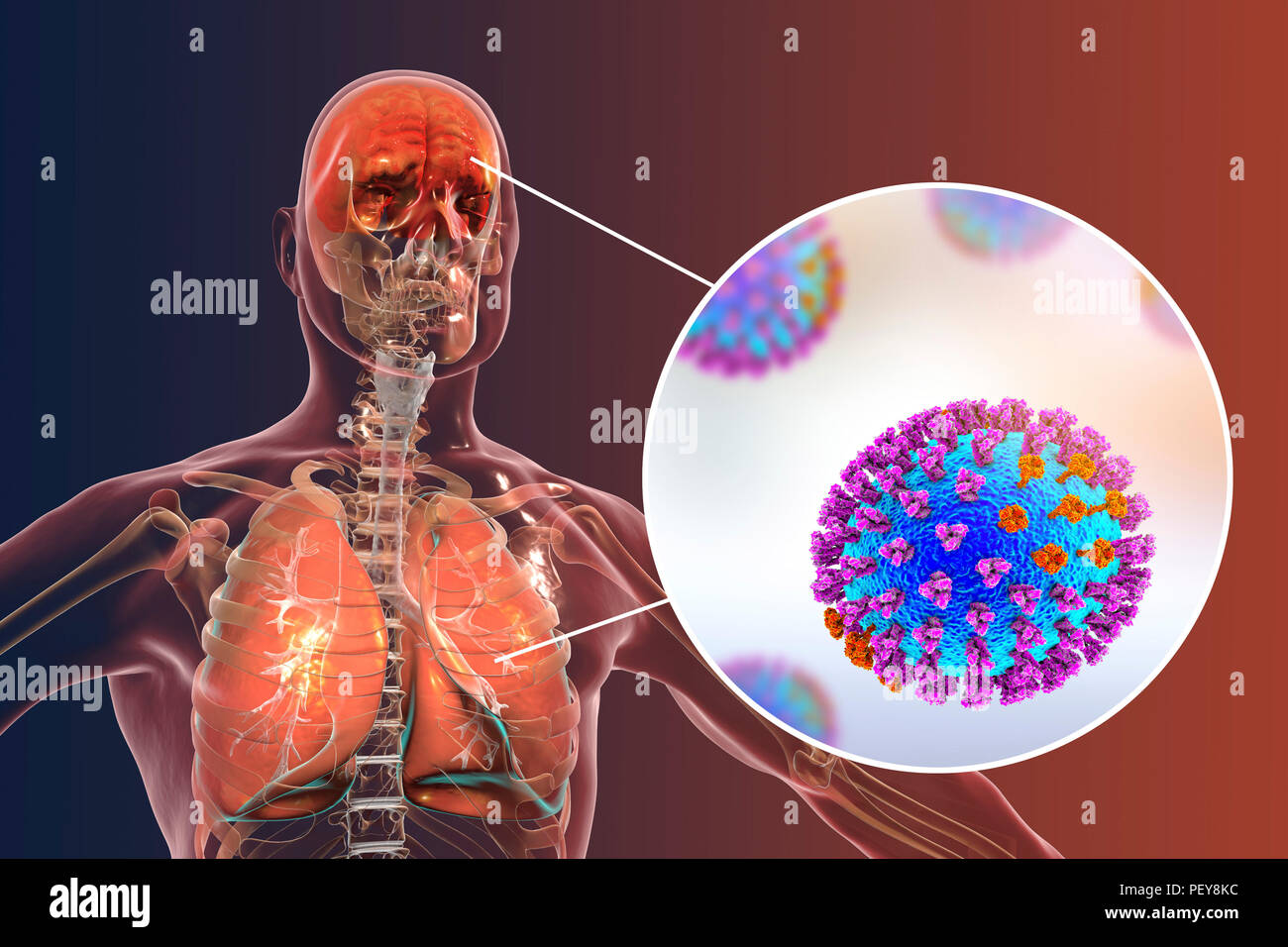 Computer illustrations showing the common complications of flu ...