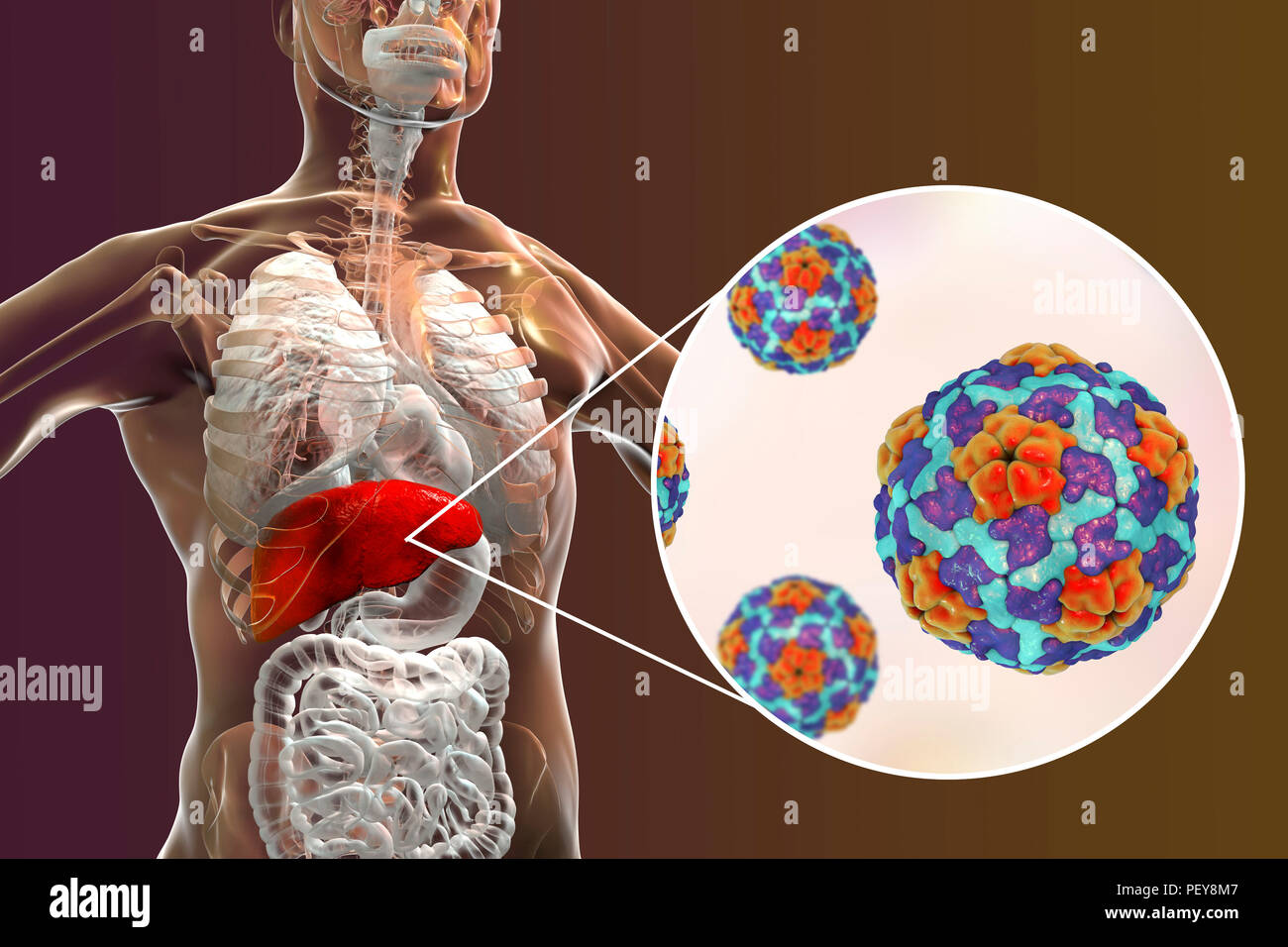 Hepatitis A infection. Computer illustration showing the liver and a ...
