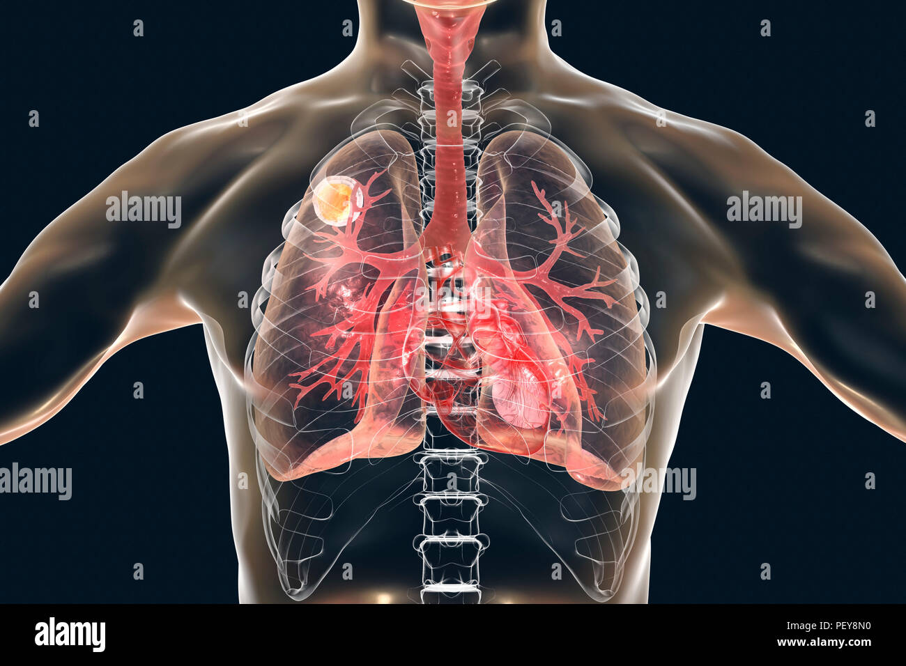Aspergilloma of the lung, computer illustration. Also known as mycetoma ...