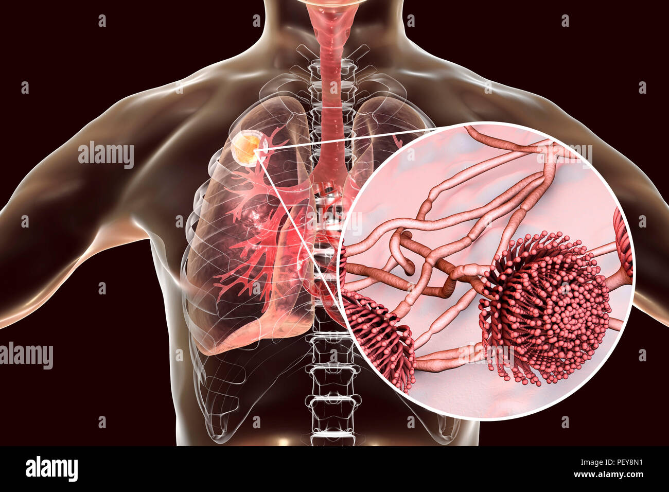 Aspergilloma hi-res stock photography and images - Alamy