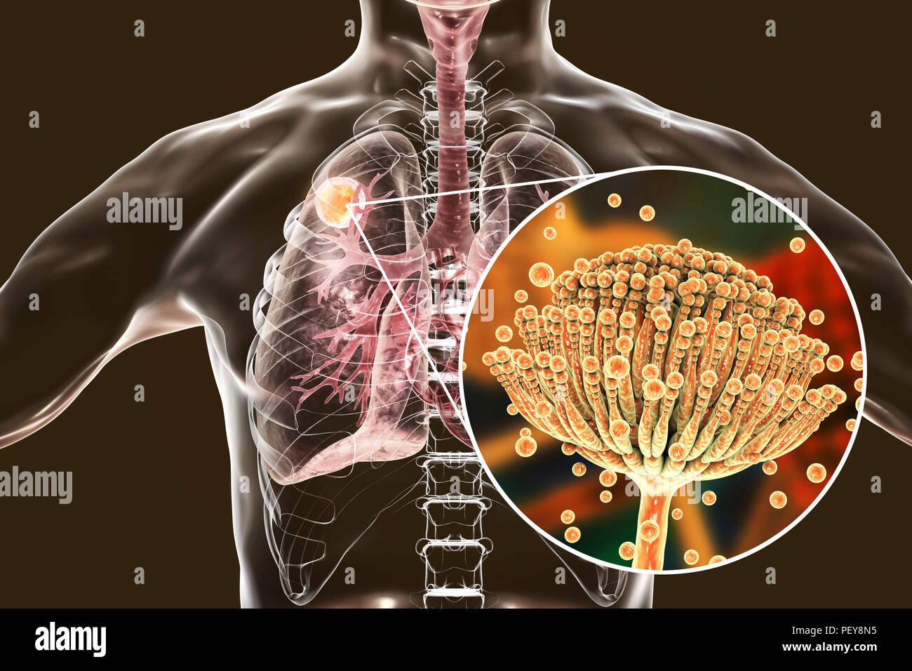 Aspergilloma of the lung and a close-up view of Aspergillus fungi ...