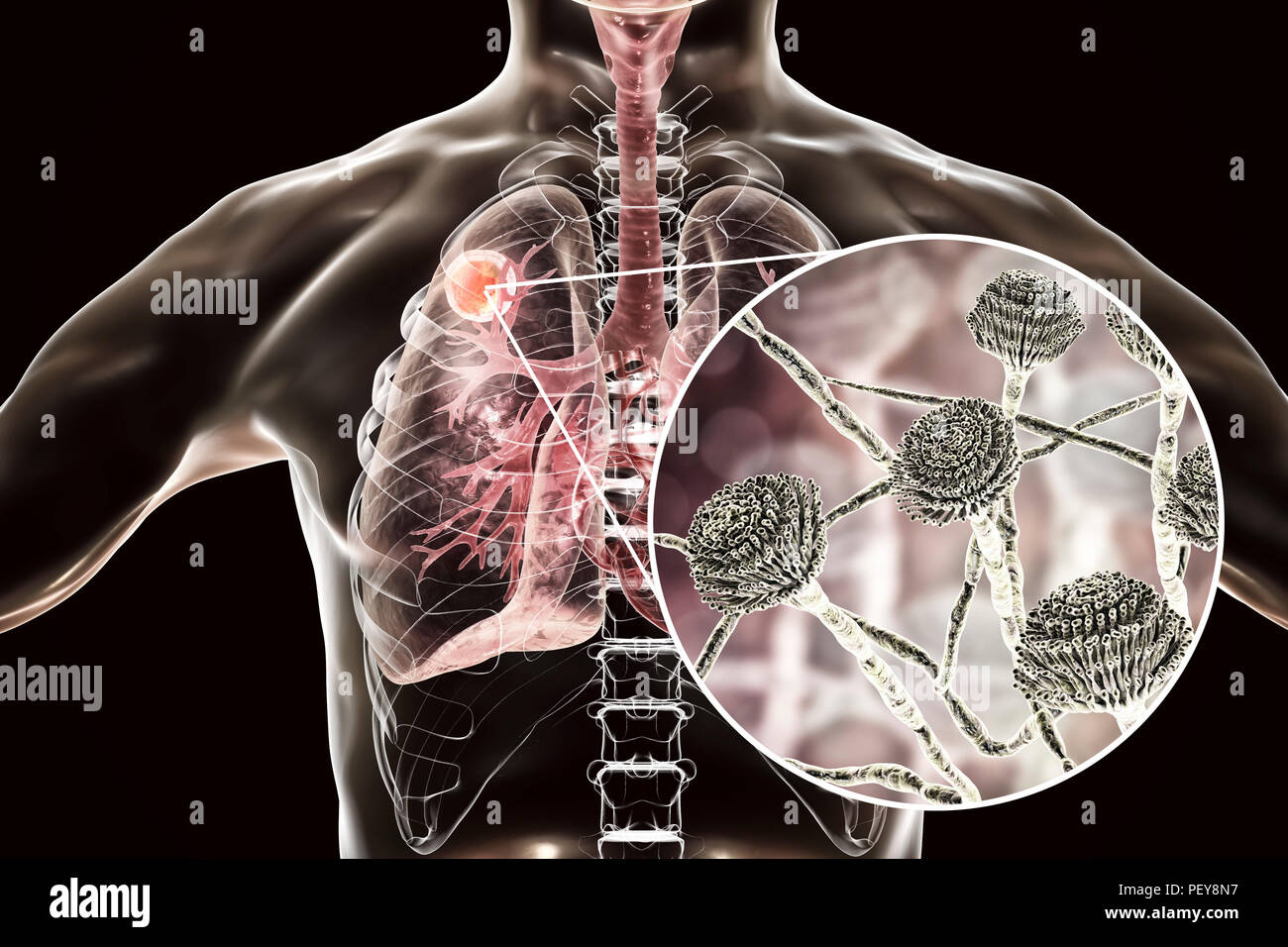Aspergilloma Of The Lung And A Close Up View Of Aspergillus Fungi Computer Illustration Also