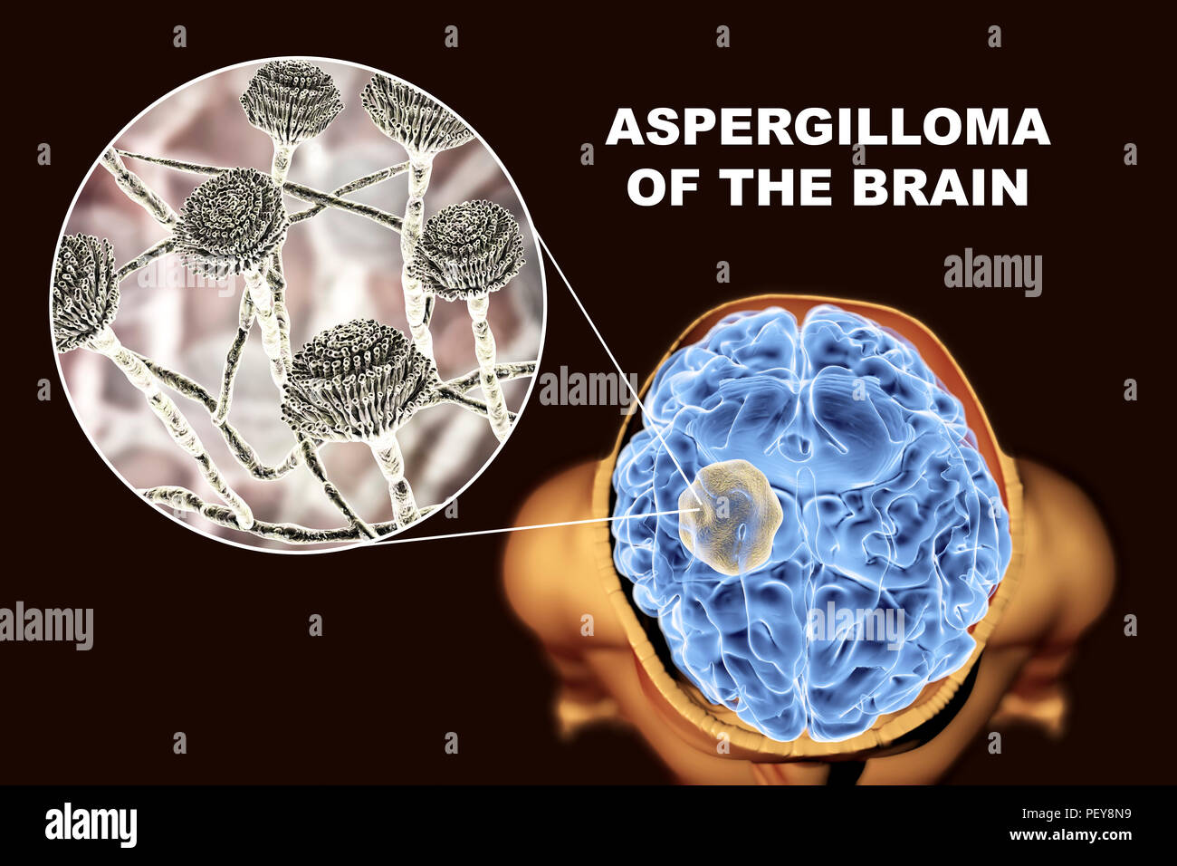 Aspergilloma fungus ball hi-res stock photography and images - Alamy