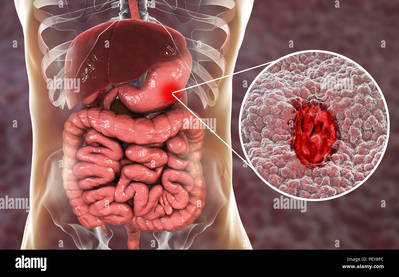 Gastric ulcer hi-res stock photography and images - Alamy