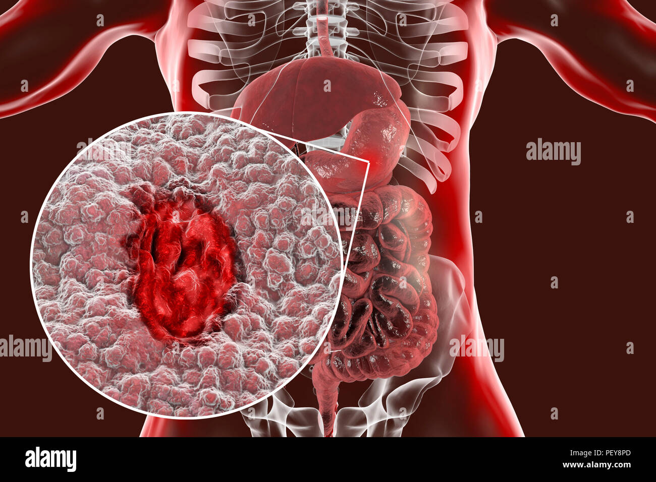 Gastric (stomach) ulcer, illustration. Gastric, or peptic, ulcers are ...