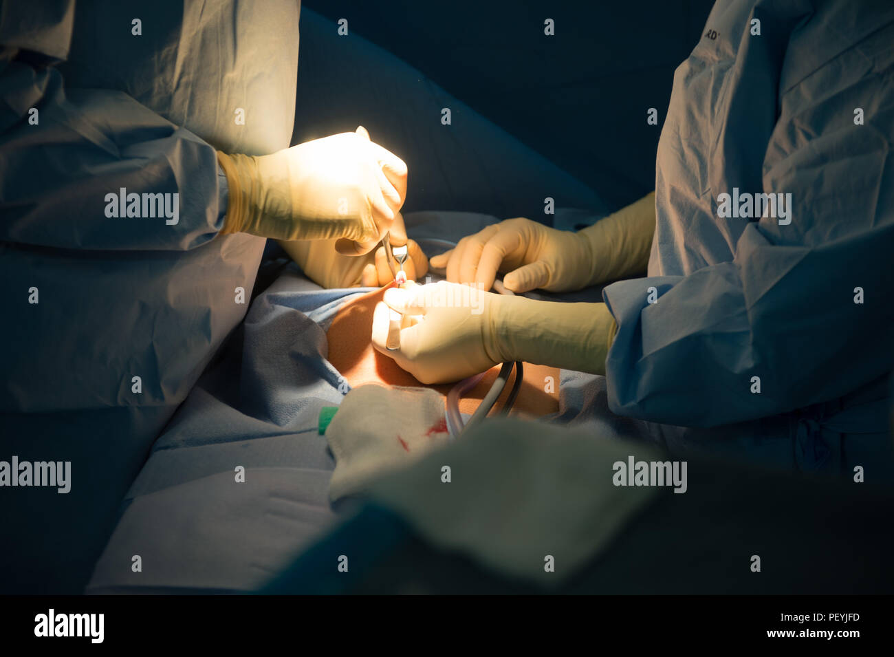 Laparoscopic appendectomy hi-res stock photography and images - Alamy