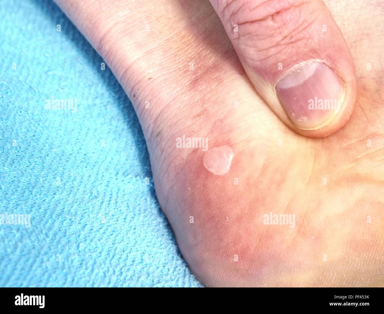 Uncraced terrible blister on human heel. Wet painful skin Stock Photo ...