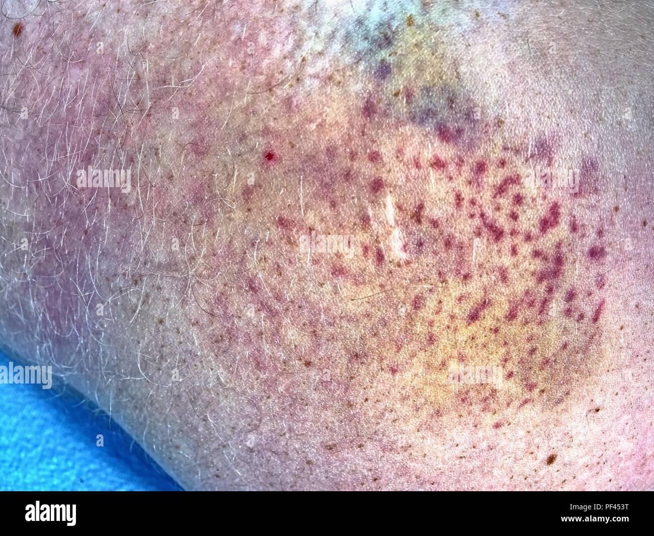 Wound Bleeding Stock Photos & Wound Bleeding Stock Images - Alamy