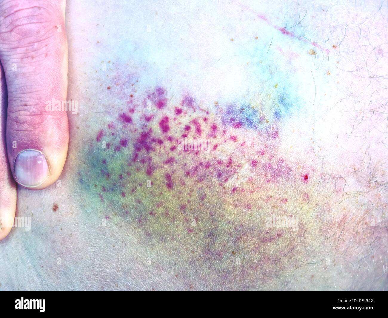 Hand embracing injured leg with painful hematoma and scratches from ...