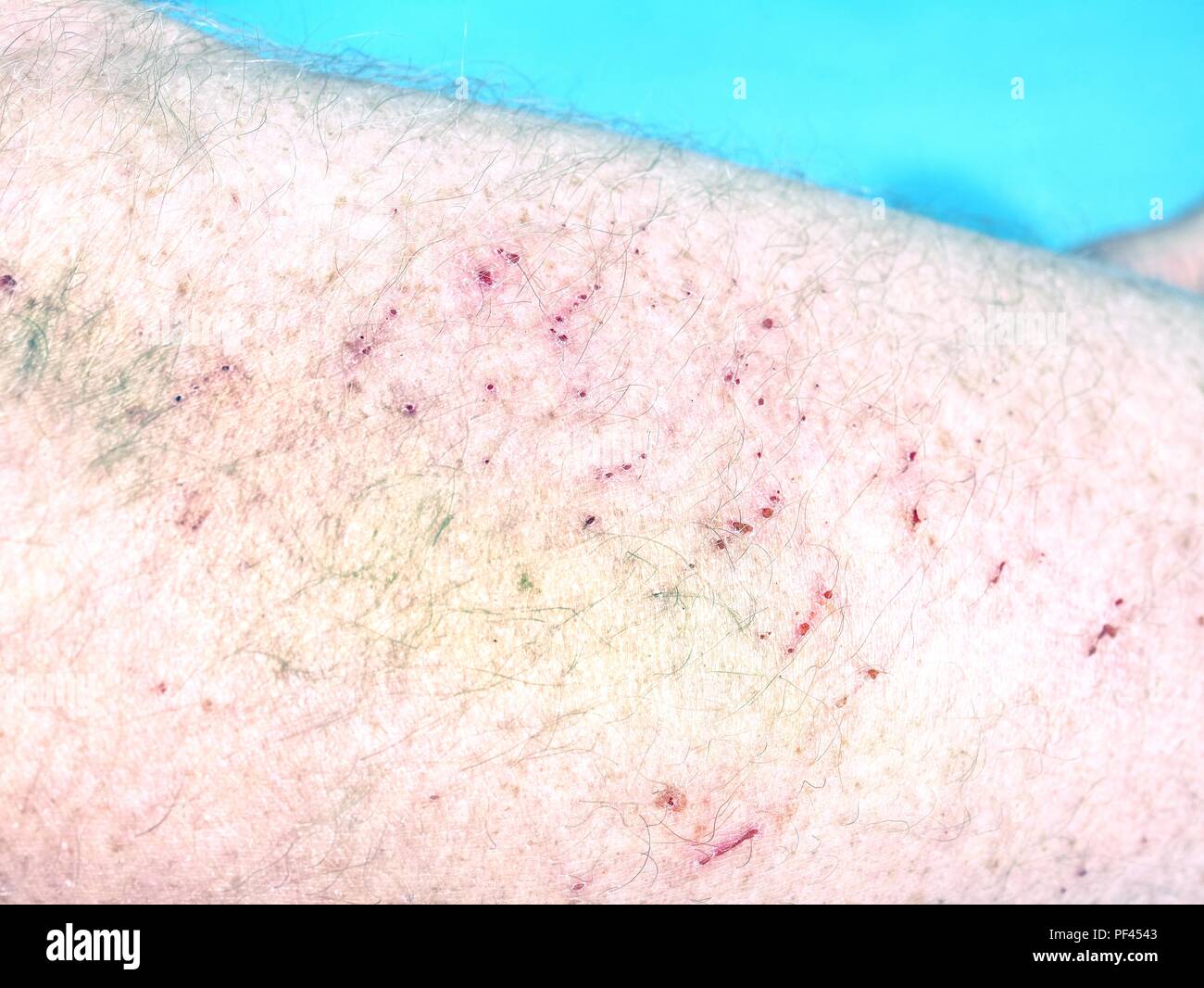 Knee Surgery Scar Stock Photos & Knee Surgery Scar Stock Images - Alamy