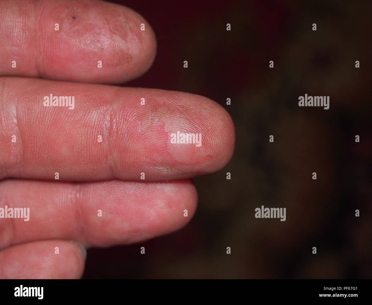Burns on the skin of fingers. Bubbles on the skin. Injury Stock Photo ...