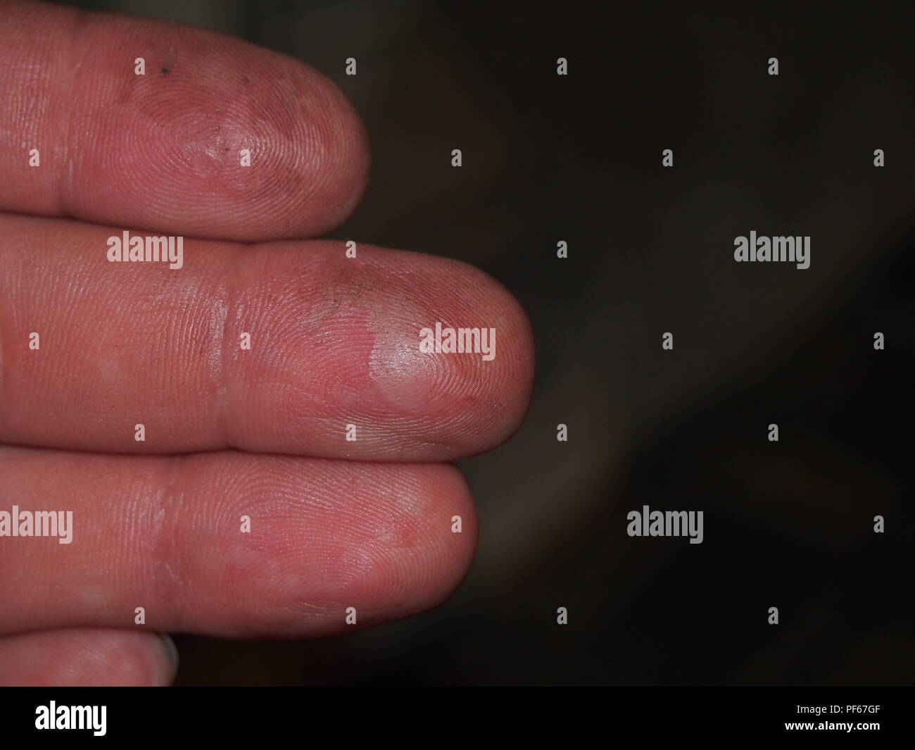 Burn Scar Hand Stock Photos & Burn Scar Hand Stock Images - Alamy