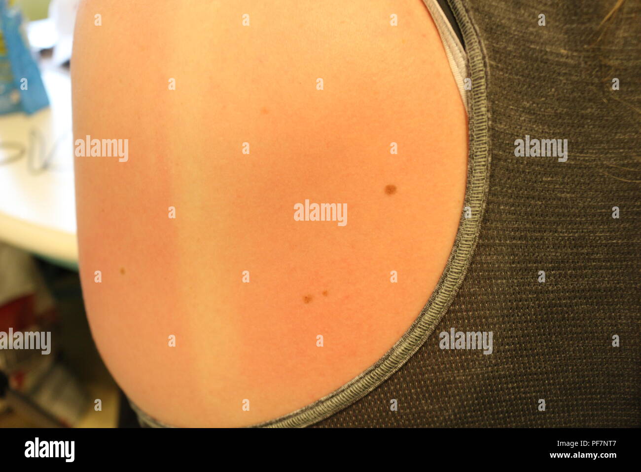 Tan lines shoulder hi-res stock photography and images - Alamy