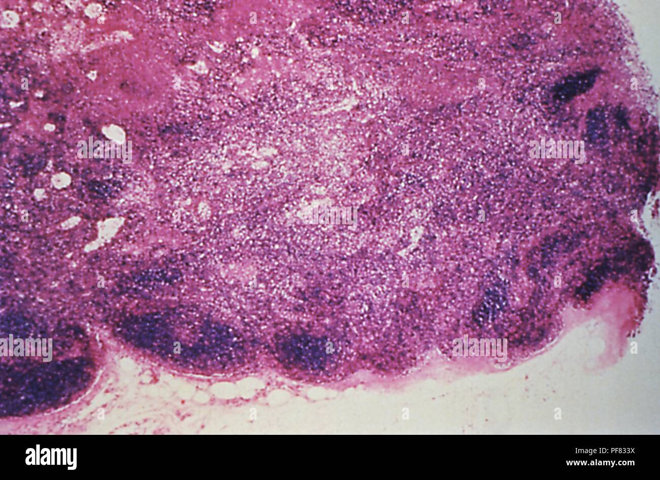 Lymph node cortex revealed in the micrograph image from a Hantavirus ...