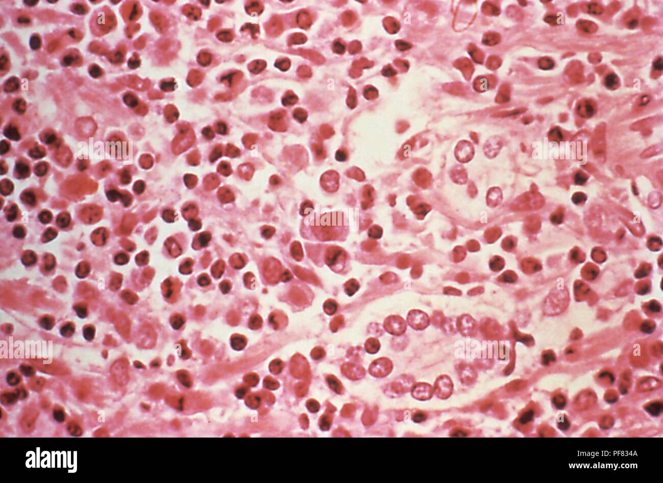 Liver tissue revealed in the micrograph image from a Hantavirus ...